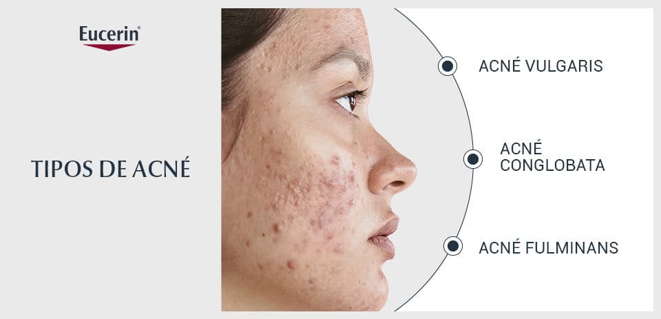 Acné en el Rostro: cómo tratar y prevenir | Eucerin®